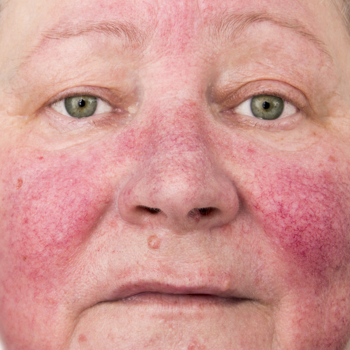 Rosacea (ruusufinni) – Ihopalvelu Shop